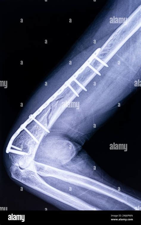 X Ray Image Of Osteosynthesis Of The Humerus Of The Left Arm Of A Man