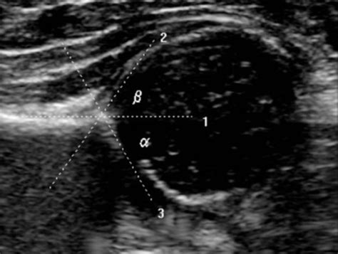 Developmental Dysplasia Of The Hip Ddh Pediatrics Orthobullets