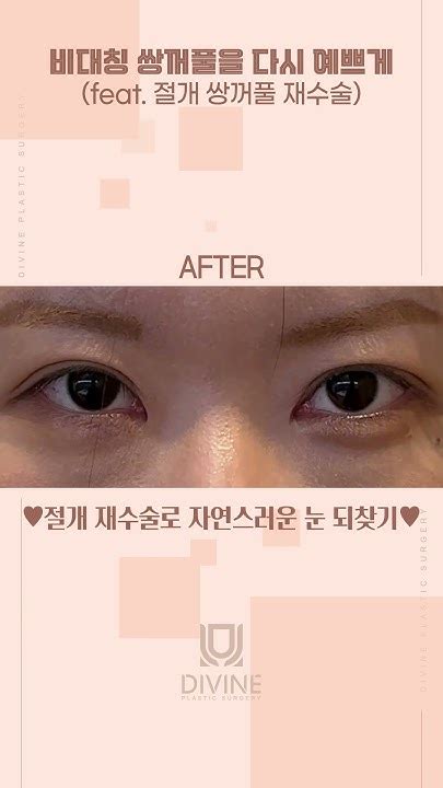 앞트임 후에 생긴 비대칭 쌍꺼풀 절개쌍꺼풀 재수술로 예쁘게 교정한 후기💜 Youtube