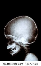Normal Skull Xray Pediatrics Patient Stock Photo Edit Now 791501545
