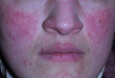 Lupus Eritematoso Sistemico Oral