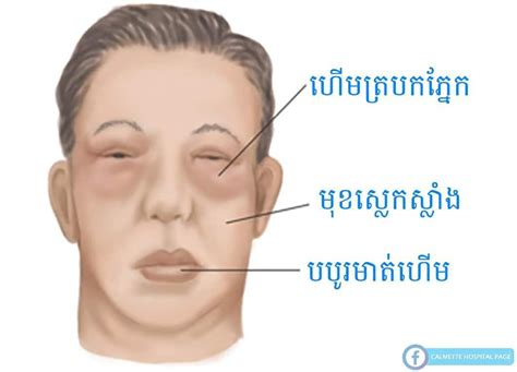 ស្វែងយល់ អំពីជំងឺទឹកនោមប្រៃ ចំពោះមនុស្សពេញវ័យ នគរដ្រេហ្គន