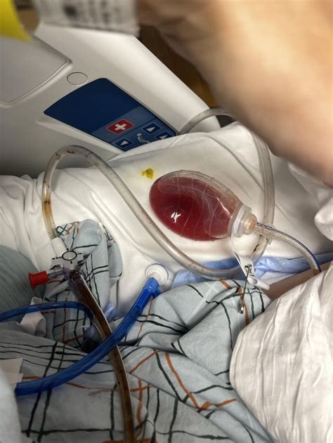 Appendix Burst Before I Could Get Into Surgery Simple Laparoscopic