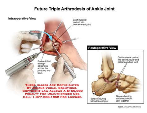 Amicus Illustration Of Amicus Surgery Foot Ankle Arthrodesis Fusion Calcaneus Talus Navicular