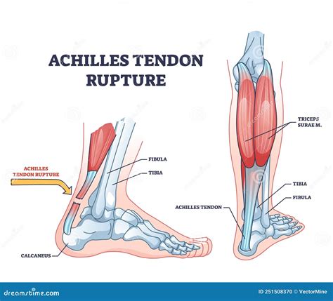 Achilles Tendon Injury Types As Leg Or Ankle Trauma Examples Outline