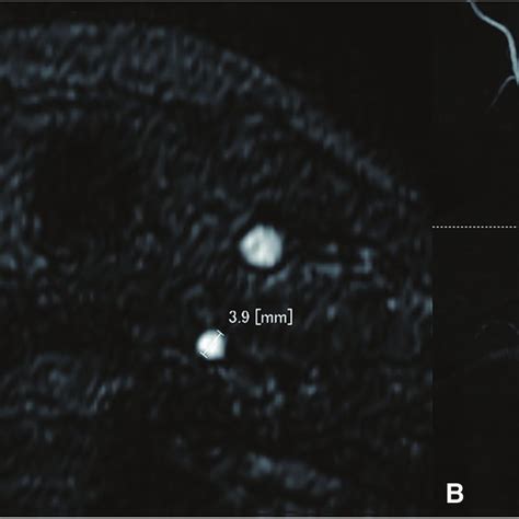 An Example Of Va Measurement By Mra The Right And Left Va Diameters Download Scientific