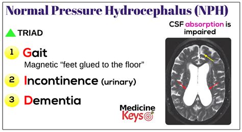 Normal Pressure Hydrocephalus