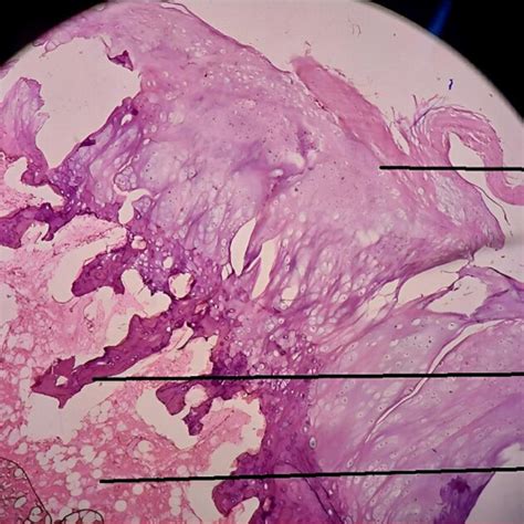 Hematoxylin And Eosin Stained Specimen Showing A Thickened