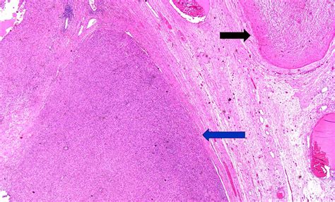 Histologia Do Neurofibroma Neupatimagem Unicamp