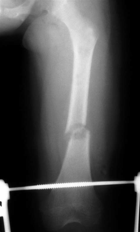 Transverse Fracture Meddic