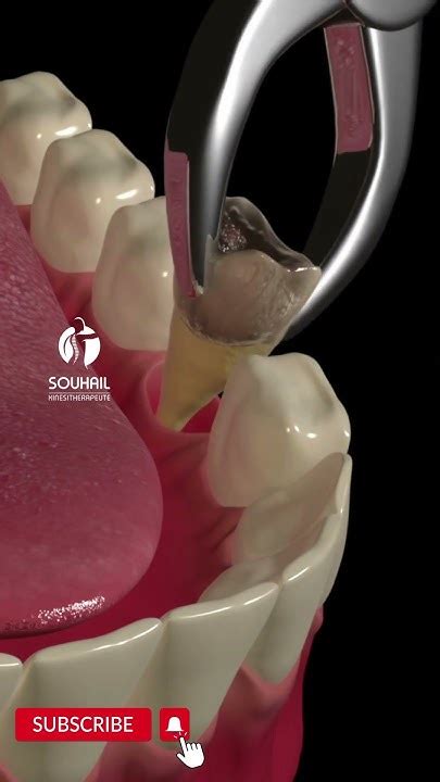 Tooth Extraction Animation Youtube