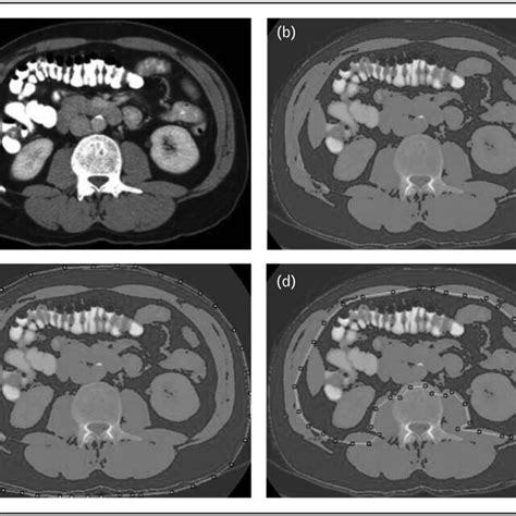 Example Of Selection Of Ct Body Composition Fat Areas Using Imagej