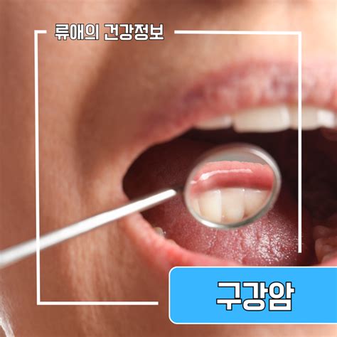 구강암전조증상 및 진단 혀암증상 구강암 4기 네이버 블로그