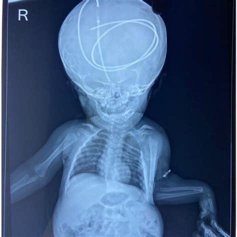 X Ray Skull Showing Completely Migrated And Coiled Intracranial Shunt