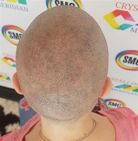 Scalp Micropigmentation Diffuse Thinning Treatments What Do I Need To