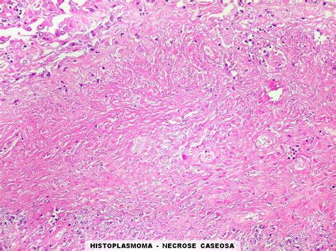 Necrose Caseosa Wood Scribd Braxin