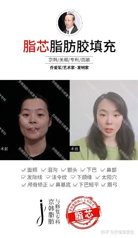 京韩脂芯自体脂肪胶填充太阳穴可以维持多久 知乎
