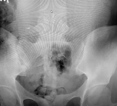 Early Sclerosis Bilateral Si Joints Download Scientific Diagram