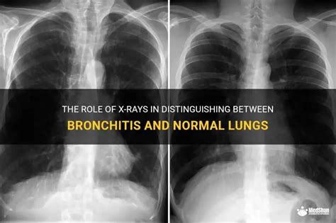 The Role Of X Rays In Distinguishing Between Bronchitis And Normal Lungs Medshun