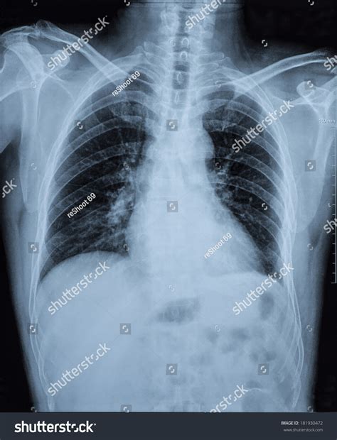 Xray Image Abnormalities Human Spinevertebral Column Foto Stok