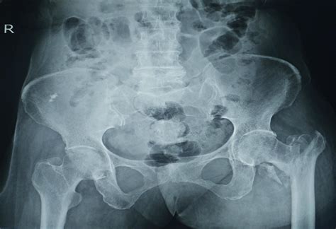 Una Radiografía Pélvica Que Muestra Una Fractura Cerrada Del