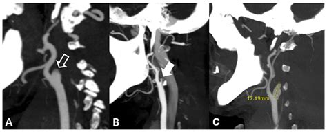 Occluded Left Internal Carotid Artery