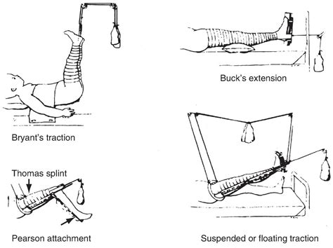 Casts Splints Dressings And Traction Musculoskeletal Key