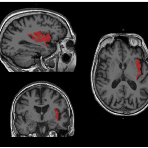 Triplanar View Of The Right Insular Cortex Using The Roi Analyses With
