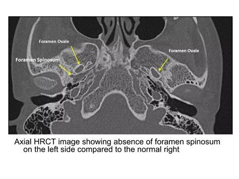 Interventional Neuroradiology Anatomy Of The Internal Carotid Artery Ica Ppt