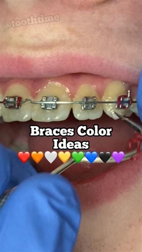 Braces Color Ideas Braces Colors Cute Braces Colors Braces Tips