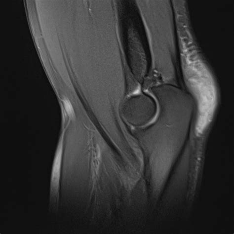 Olecranon Bursitis Pacs