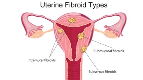 Fibroids Heavy Menstrual Bleeding