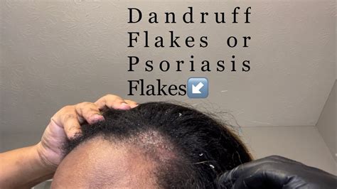 Scratching Dandruff Psoriasis Flakes Picking Scabs On Scalp