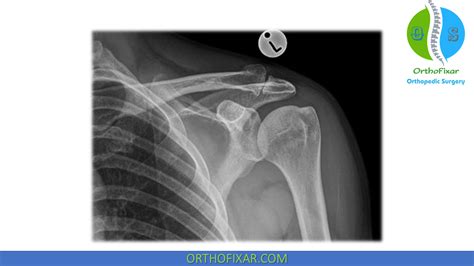 Ac Joint Arthritis Orthofixar