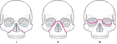Imagele Fort Classification Of Midface Fractures Msd Manual