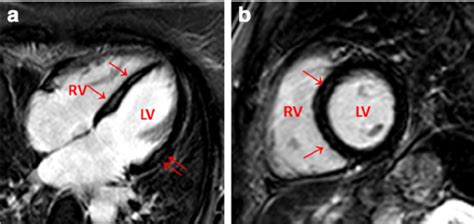 A B Late Enhancement Image Of One Patient With Exercise Induced Pvbs Download Scientific