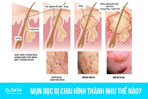Mụn Chai Là Gì Nguyên Nhân Cách điều Trị Và Ngăn Ngừa Phòng Khám O2
