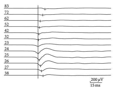 Effects Of Vpa On The Initiation And Propagation Of The Interictal