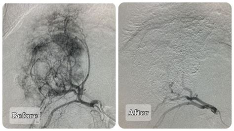 Ahmed Bessar On Linkedin In Hepatic Chemoembolization Don T Neglect