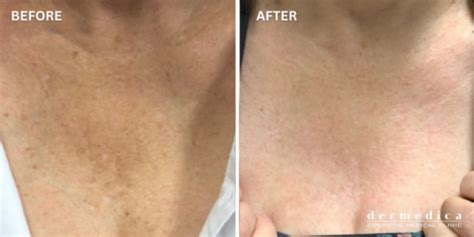 Neck Pigmentation Unveiled Causes And Effective Treatment Options