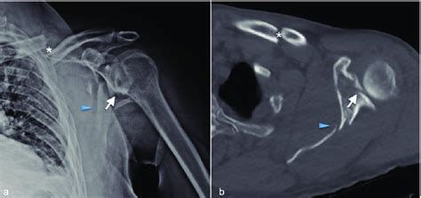 Combined Glenoid Fracture White Arrow Type V With Displacement Of