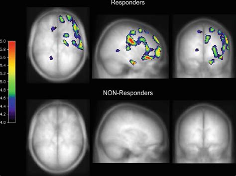 4 Maximum Intensity Projection Of The T Values Spm8 P