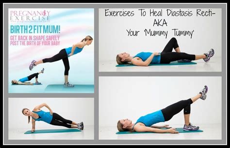 Diastasis Recti Exercises Pregnancy Exercise