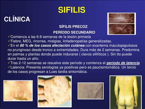 Ppt Sifilis Powerpoint Presentation Free Download Id 4150781