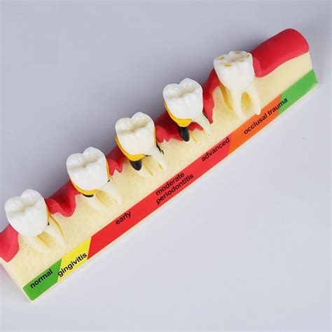 Dental Caries Disease Teeth Model M4010 Dental Edu Vicedeal