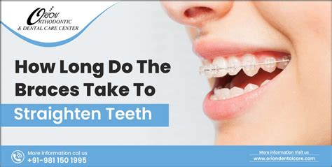 How Long Do Braces Take Duration And More Orion Dental Care