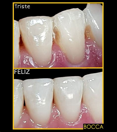 Resinas de Alta Estética Sistema R A T By Bocca Clínicas Dentales