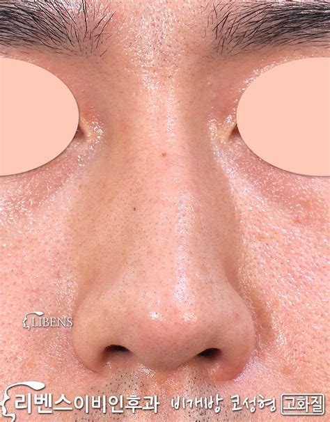 비개방 매부리코성형 휜 코 교정 낮은 복코 코끝 수술 남성 전후사진 S1209