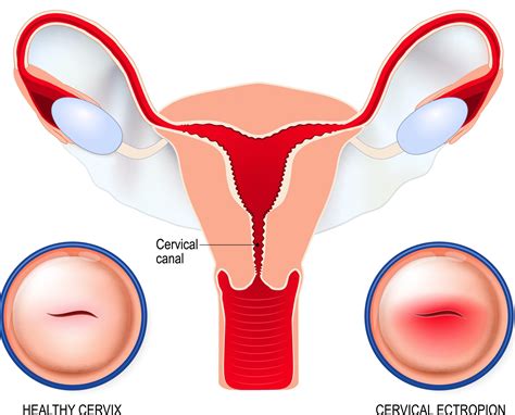 Cervical Ectropion During Pregnancy Cervicitis Causes Symptoms