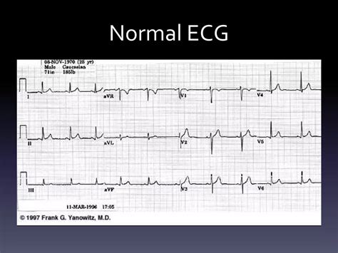 Systematic Ecg Interpretation Pptx